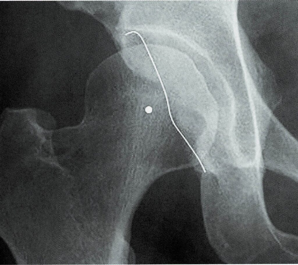 図9 Posterior wall sign