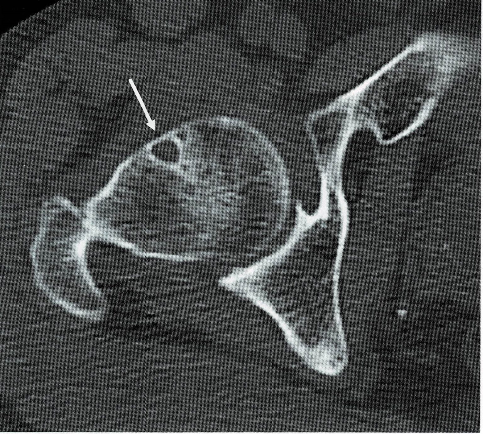 図12 Herniation pit