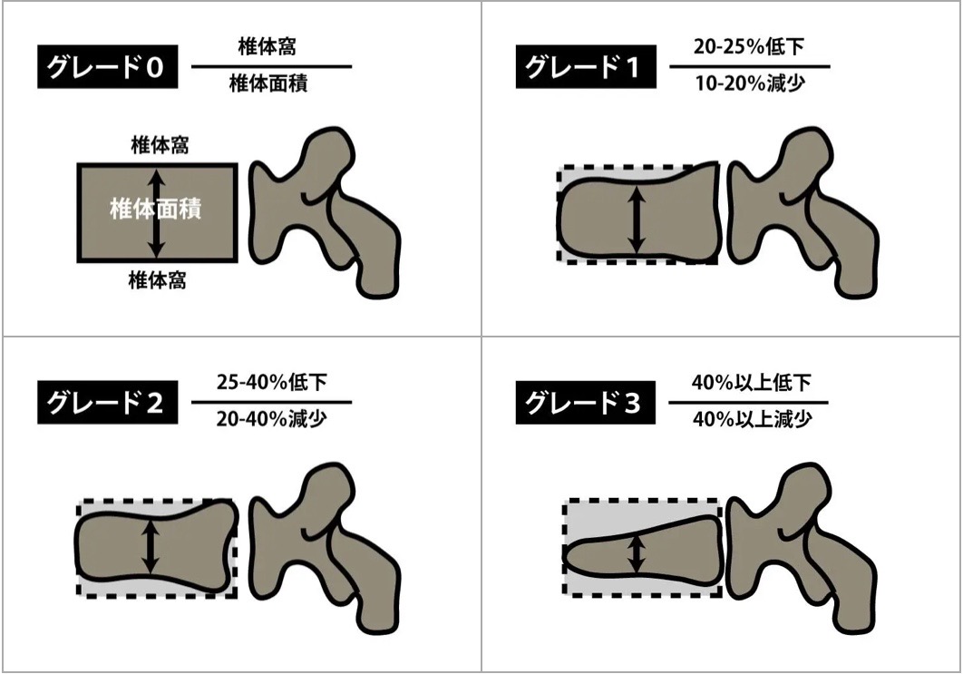 グレード0：正常