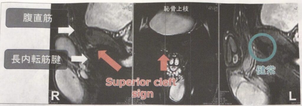 superior cleft sign