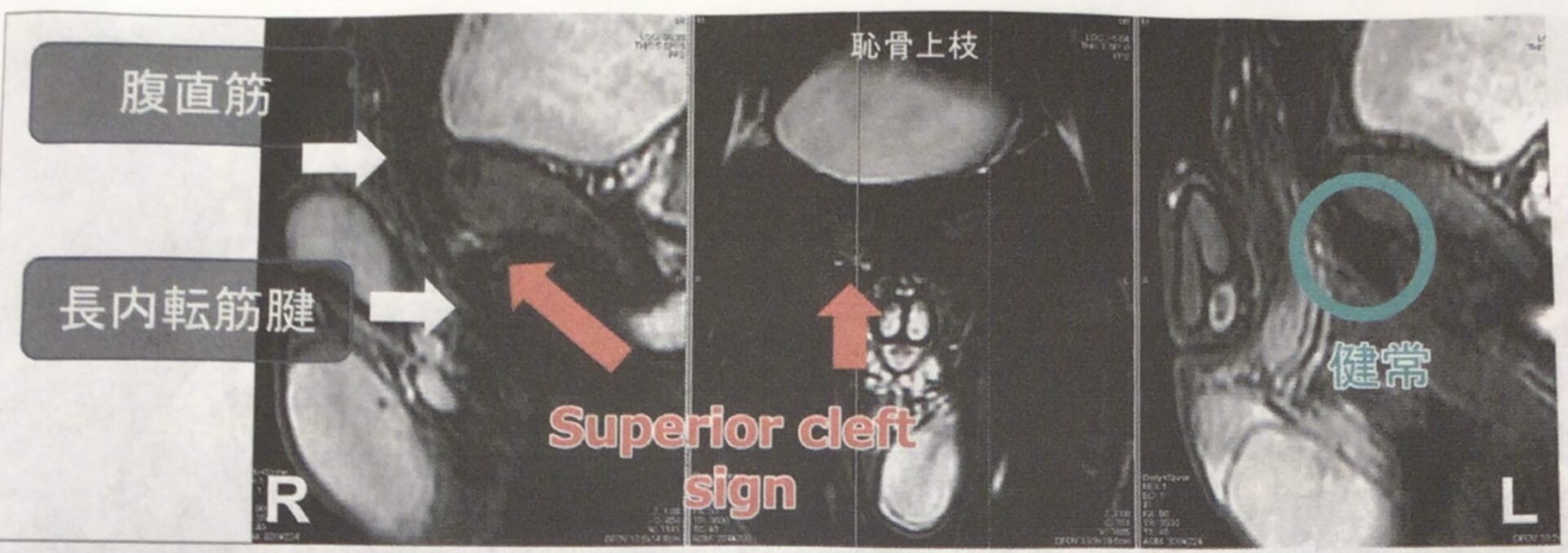 superior cleft sign