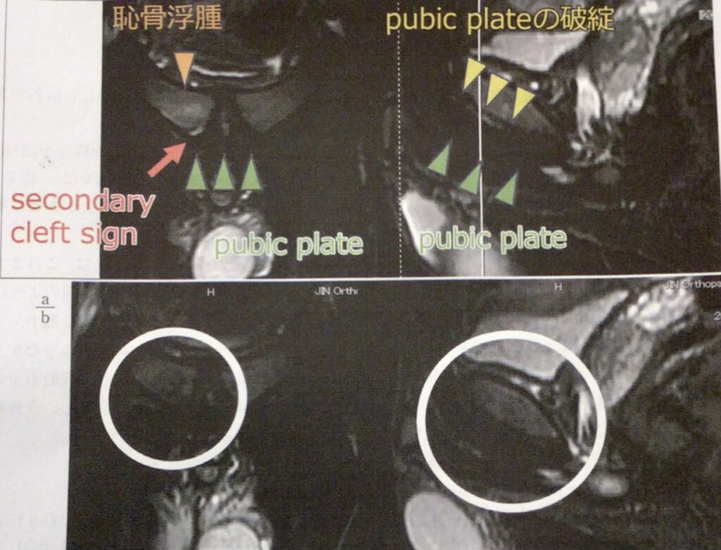 secondary cleft sign