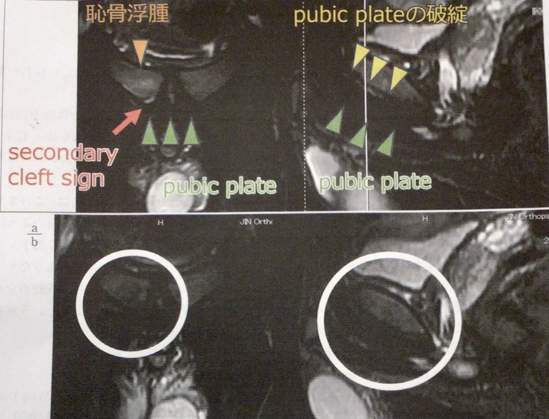 secondary cleft sign