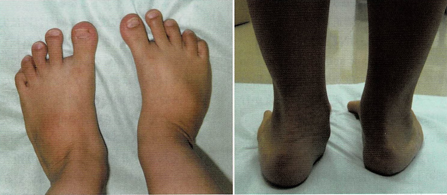 図3 skew foot(スキュー・フット)