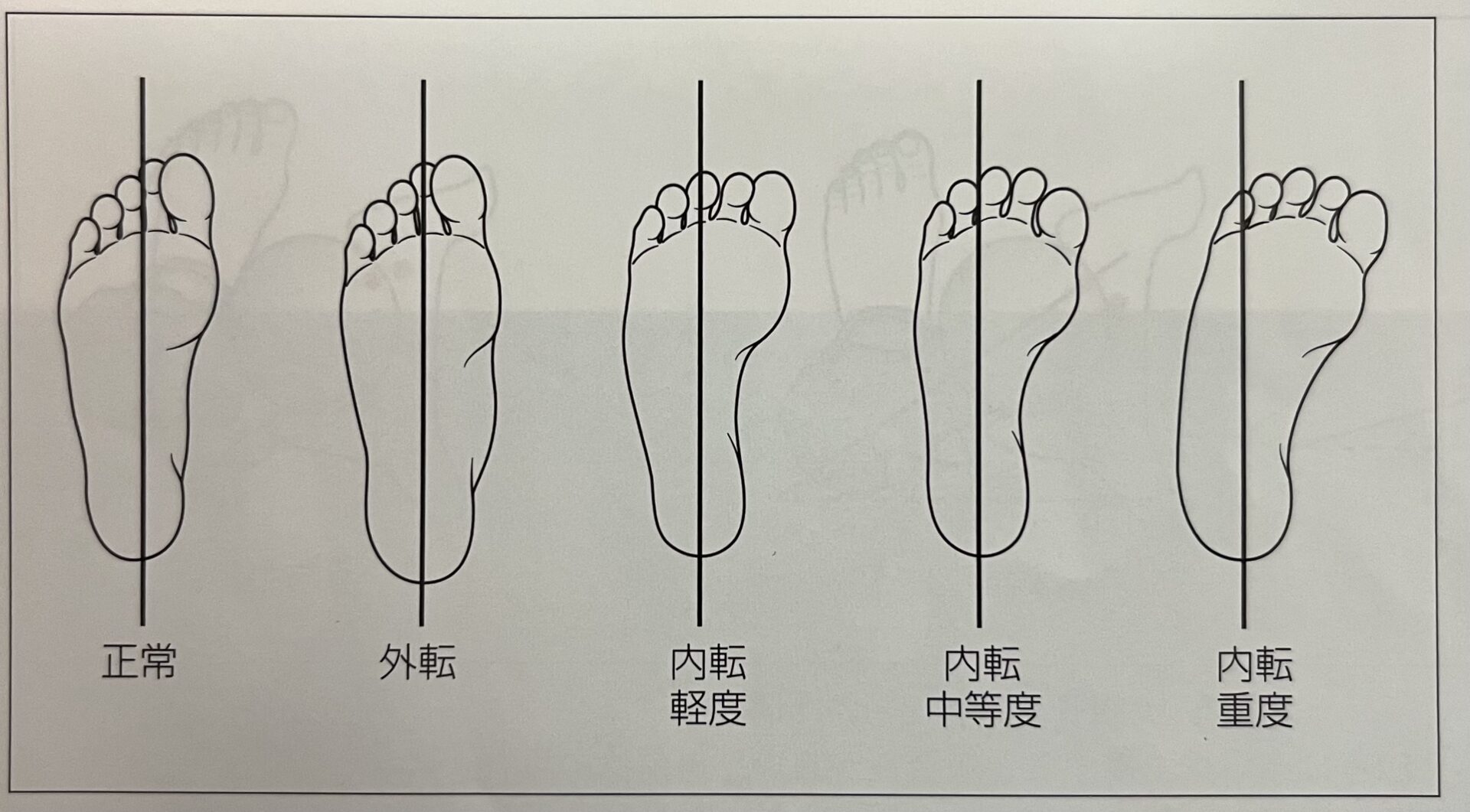 ※左の図から足部の評価(Heel bisector line)、下腿の評価(Thigh foot angle)、大腿骨前捻の評価