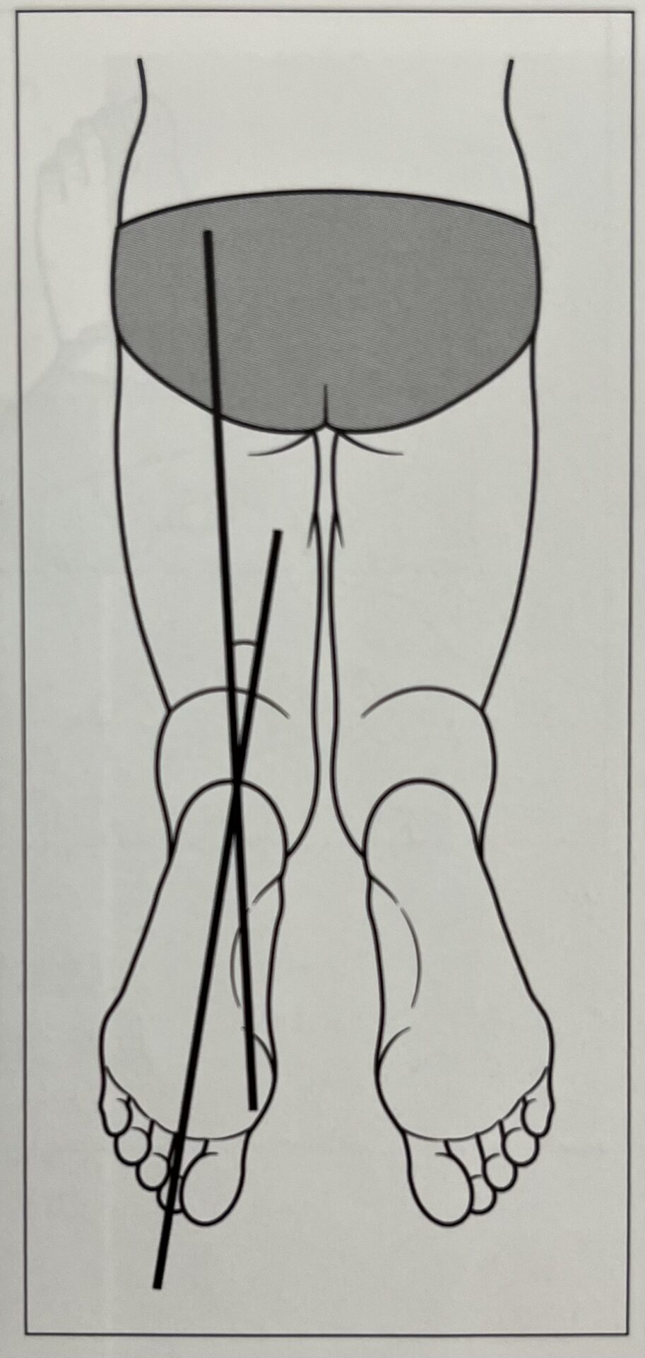 ※左の図から足部の評価(Heel bisector line)、下腿の評価(Thigh foot angle)、大腿骨前捻の評価